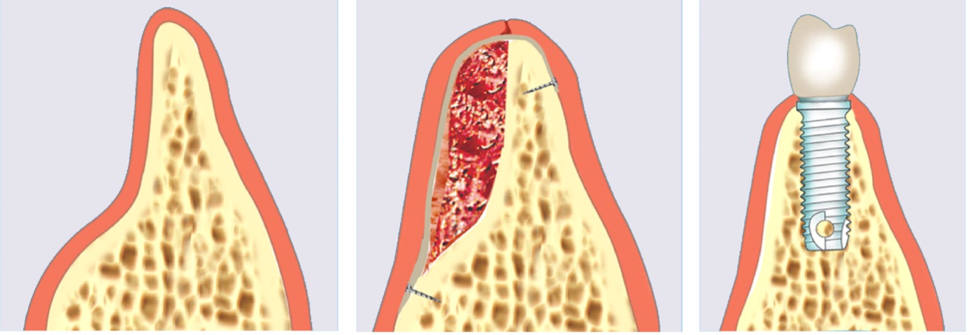 Εμφυτεύματα
